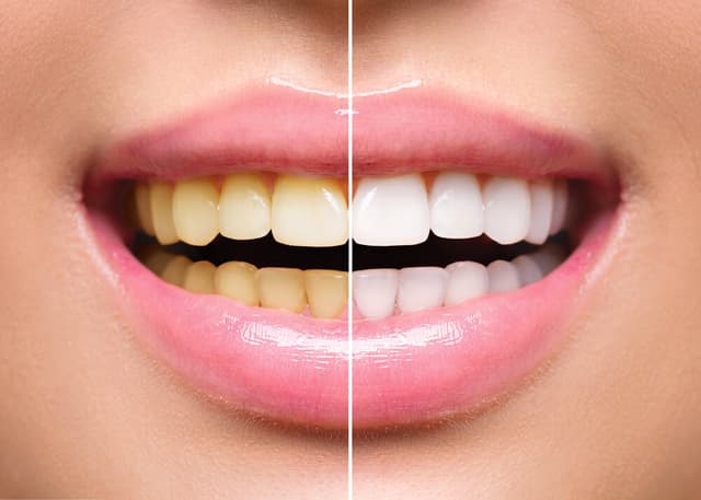 Teeth Whitening Santa Clara – Brighten Your Smile